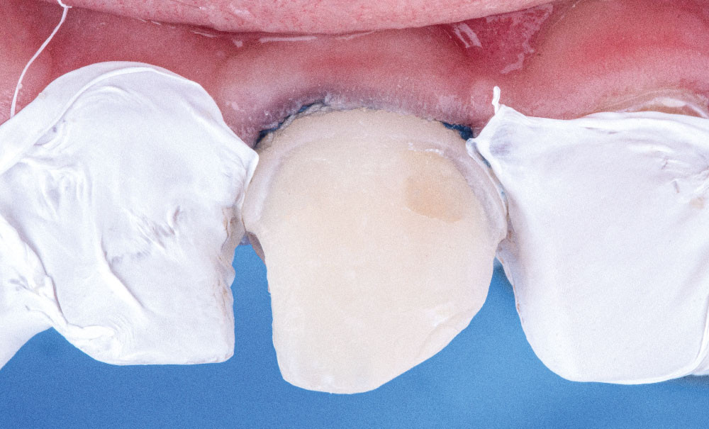 Composites stratifiés et composites injectés : deux philosophies ...