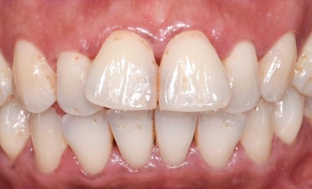 Nouvelle classification… et parodontite – stade III grade B #8 – L ...