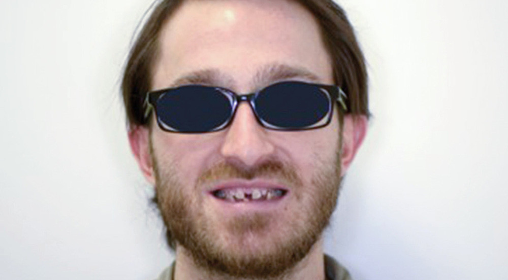 Réhabilitation esthétique et fonctionnelle d’un patient atteint de ...