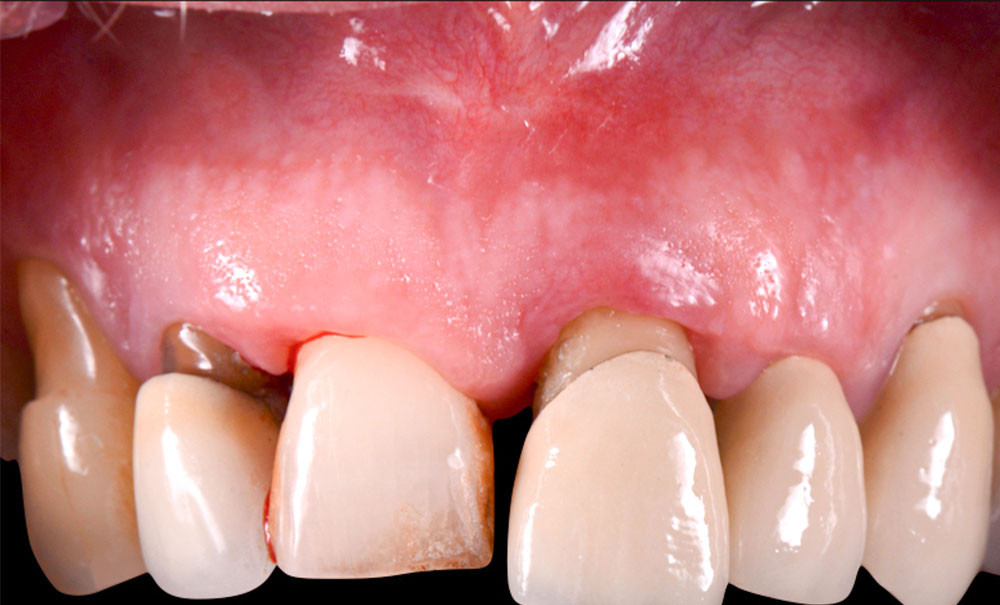 Implant chez le patient parodontal : la solution idéale ? – L ...