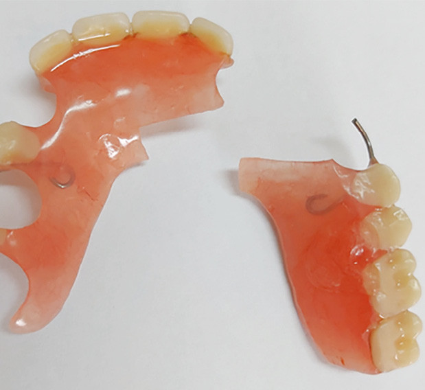 Techniques de réparation des prothèses amovibles partielles en résine ...