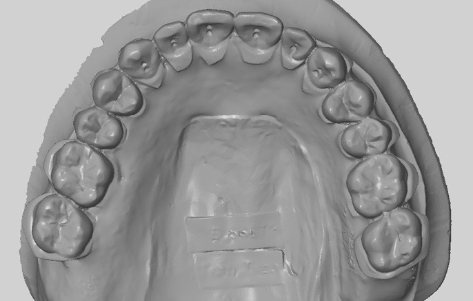Agénésie d’une incisive inférieure : et si on rajoutait plutôt une ...
