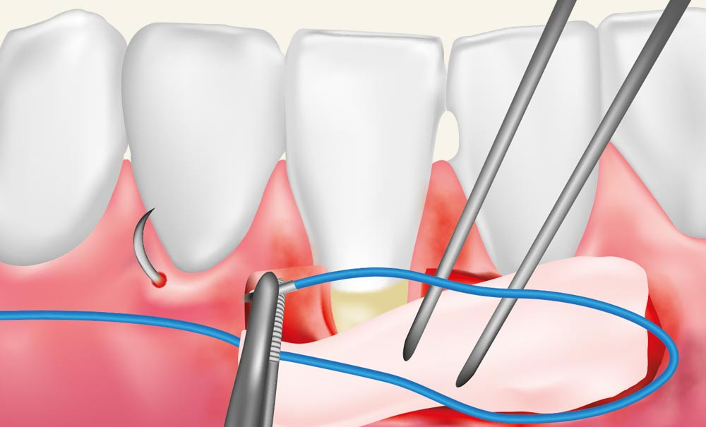 La greffe épithélio-conjonctive : incisions et sutures pas à pas – L ...