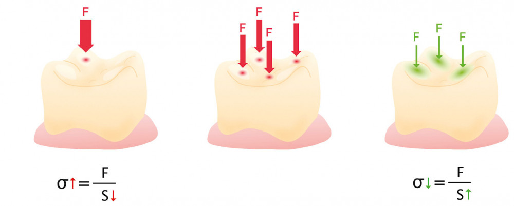 Le bridge collé cantilever postérieur en céramique – Partie 2. – L ...