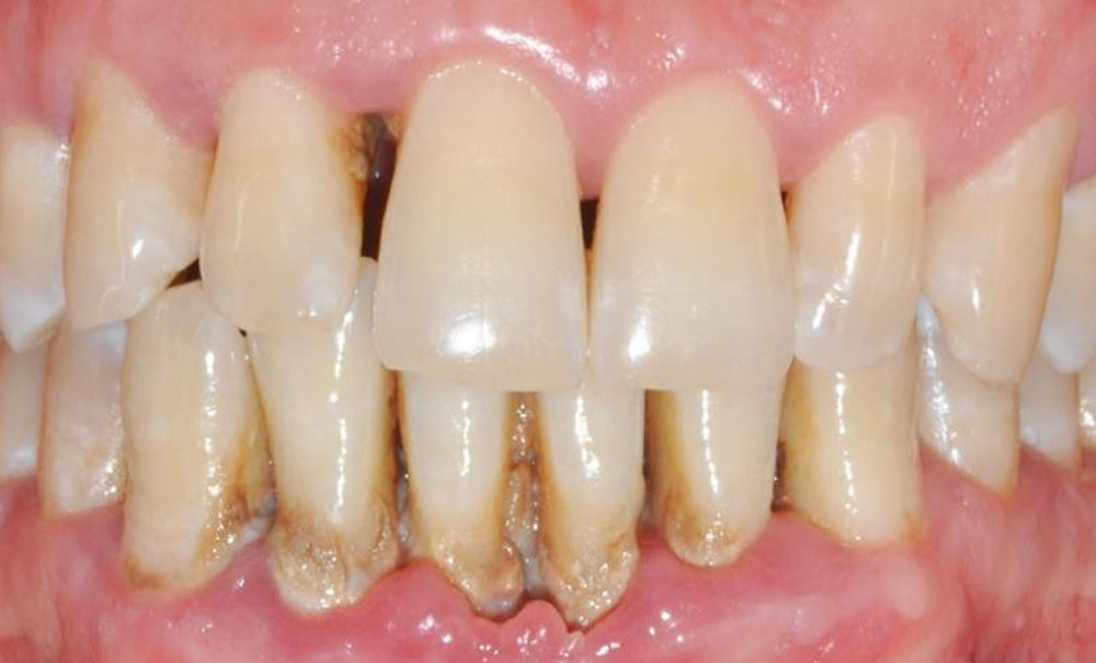 Données probantes et recommandations pour l’étape 2 de la thérapie ...