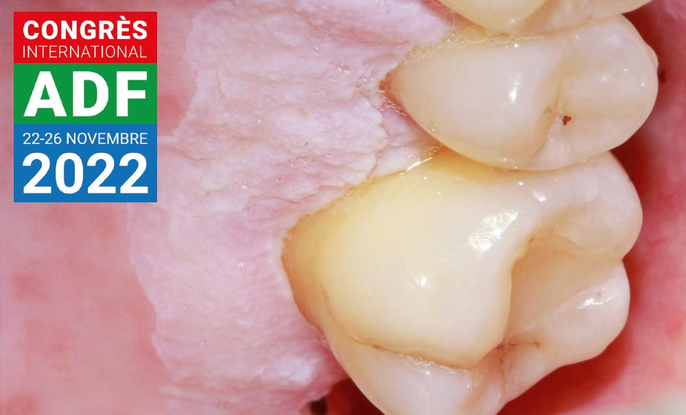 Lésions de la muqueuse gingivale en pratique quotidienne : le lichen ...