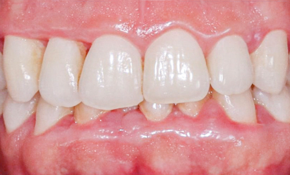 Nouvelle classification… Parodontite stade 3 grade C #8 – L'Information ...