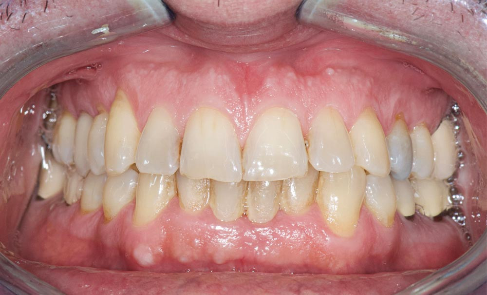 Évaluation du Risque Dento-Parodontal (RDP), un outil pour tous pour la ...