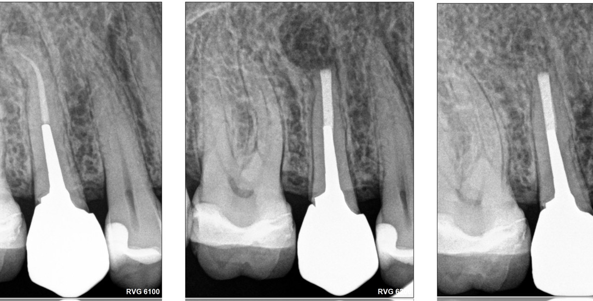 Retraitement orthograde ou chirurgical : comment choisir ? – L ...