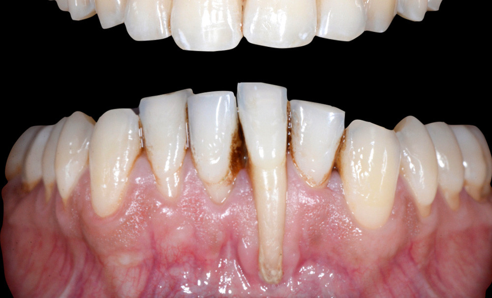 Le syndrome du fil, d’une détection précoce difficile au repérage aisé ...
