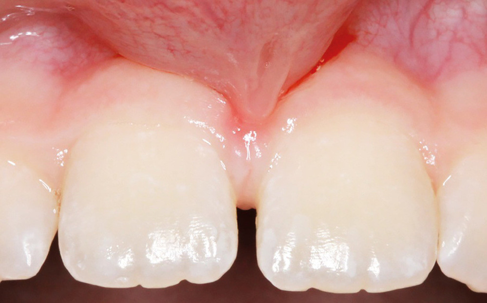 Gestion d’une complication parodontale dans un contexte de fermeture ...