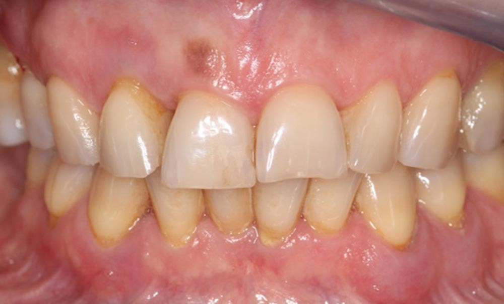 Nouvelle classification… #9 – Parodontite stade IV grade B – L ...