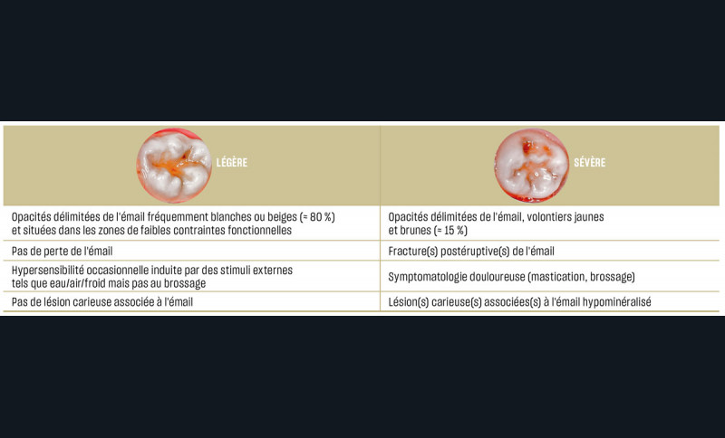 Vous connaissez les MIH, découvrez les HSPM – L'Information Dentaire