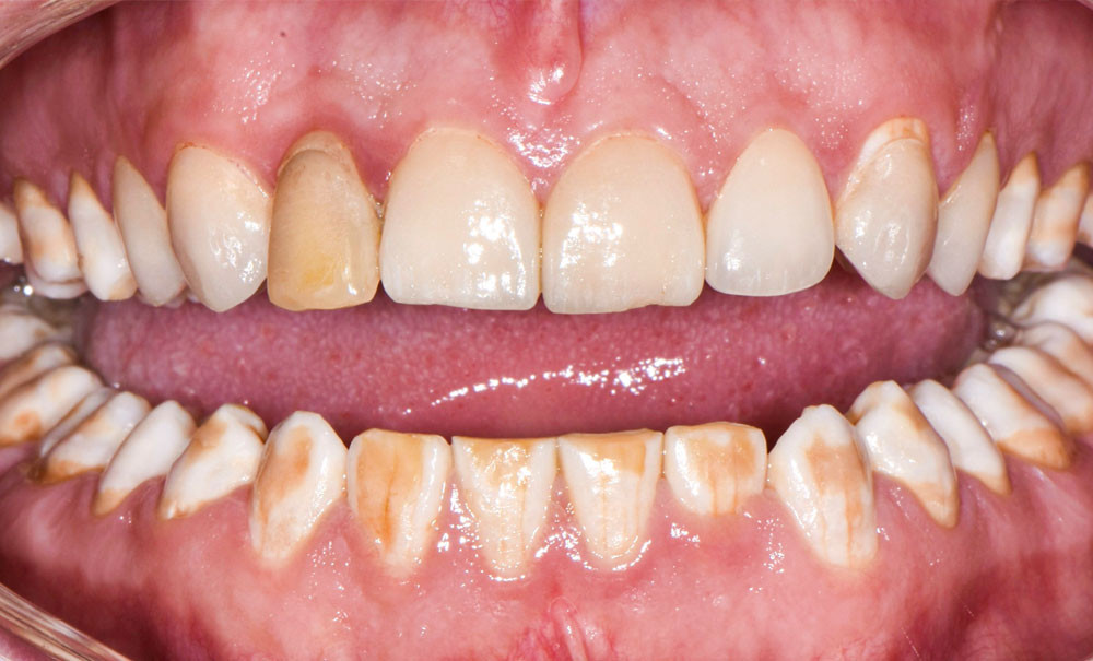 La résine infiltrante Icon® comme solution face aux hyperesthésies ...