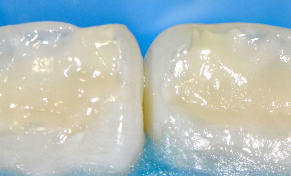 Les hypominéralisations de l’émail en toute simplicité Partie 1 : Bien ...