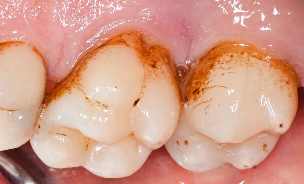 Gestion d’une lésion inter-radiculaire sur une molaire maxillaire – L ...