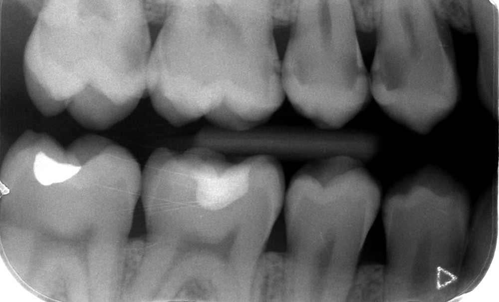 Gestion du processus carieux : les dernières recommandations issues de ...
