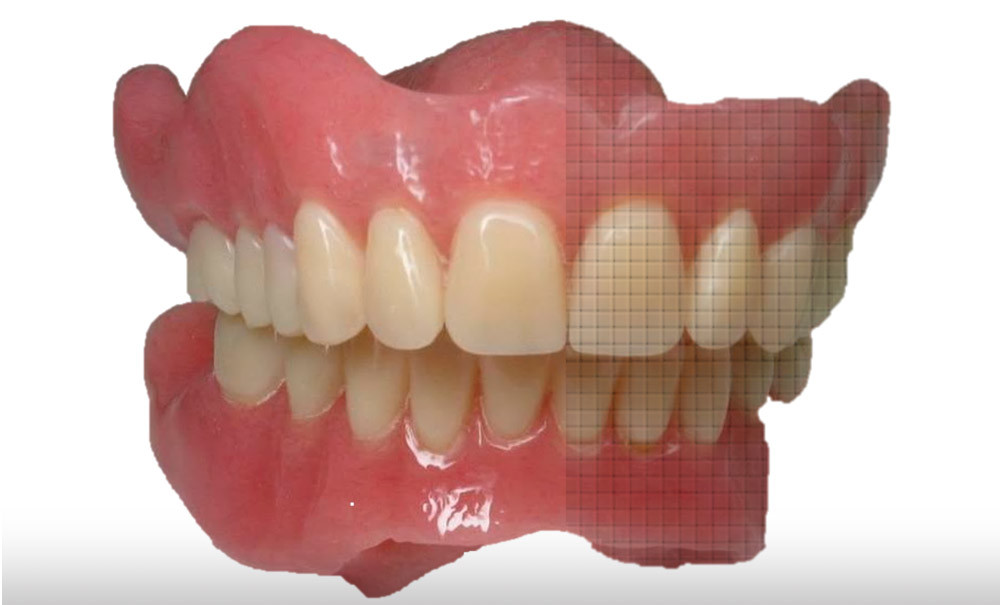 Prothèses à base résine, mise en œuvre conventionnelle ou impression 3D ...