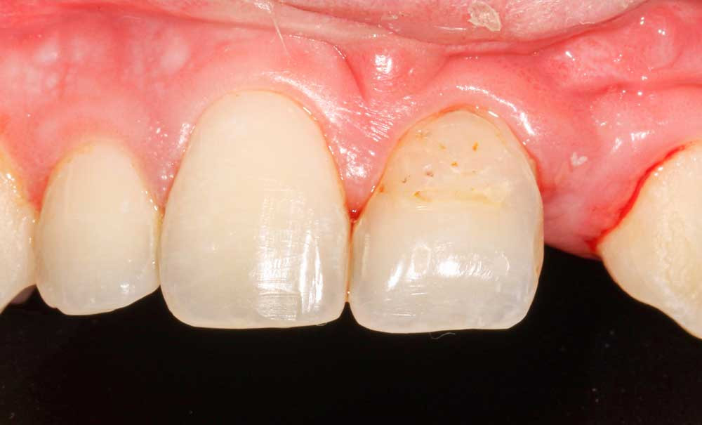 Agénésie d’incisive latérale, le bridge cantilever périphérique : une ...