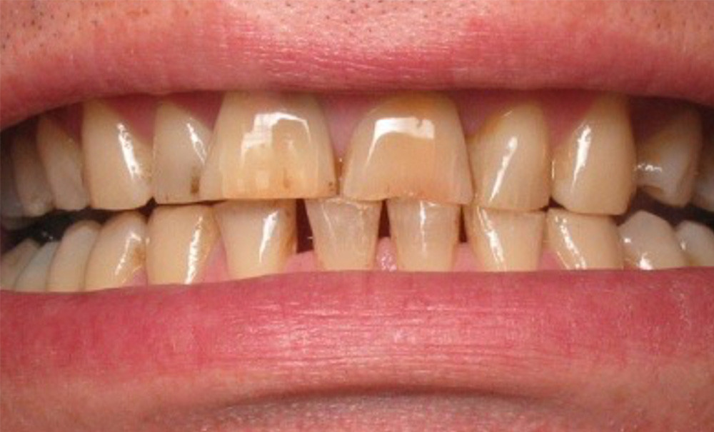 Bruxisme nocturne, corrections occlusales et controverses – L ...