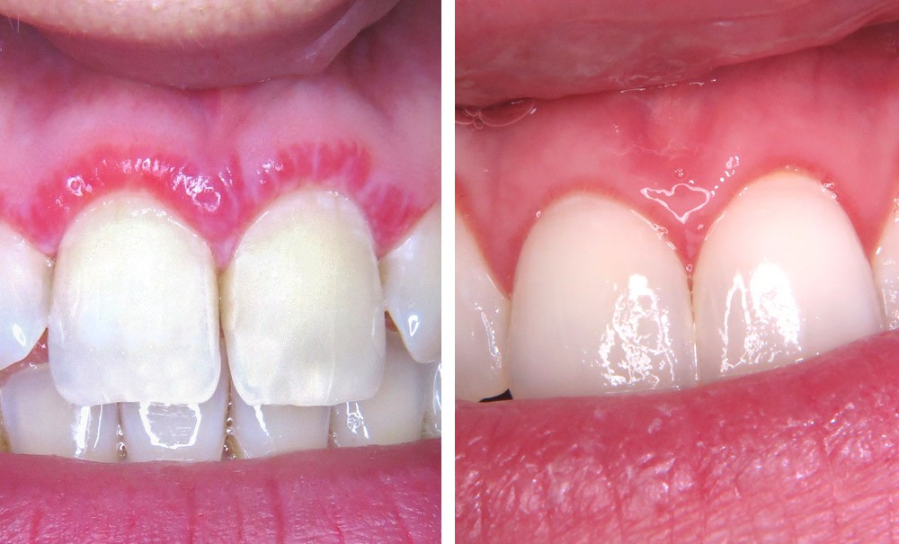 Érythème linéaire gingival : ce n’est pas toujours une gingivite due à ...