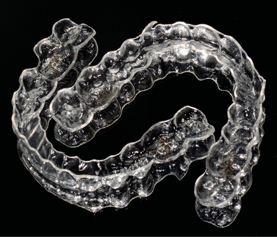 Le nettoyage des aligneurs orthodontiques – L'Information Dentaire