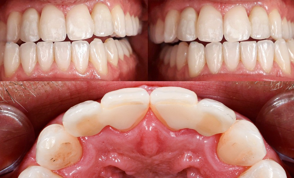 Optimiser le collage des bridges cantilever – L'Information Dentaire