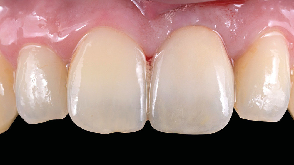 En images : le challenge de l’incisive centrale, optimisation du ...