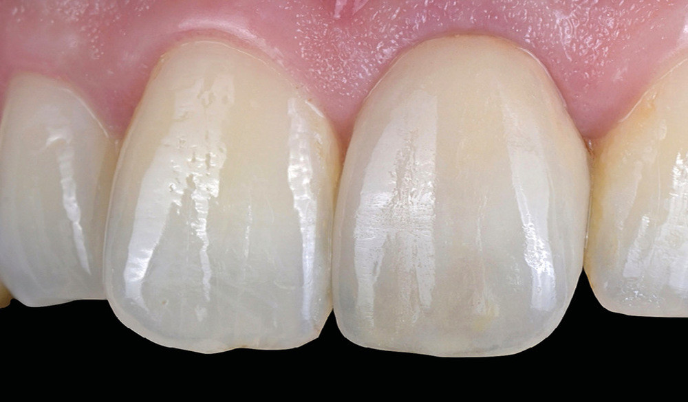 En images : le challenge de l’incisive centrale, optimisation du ...