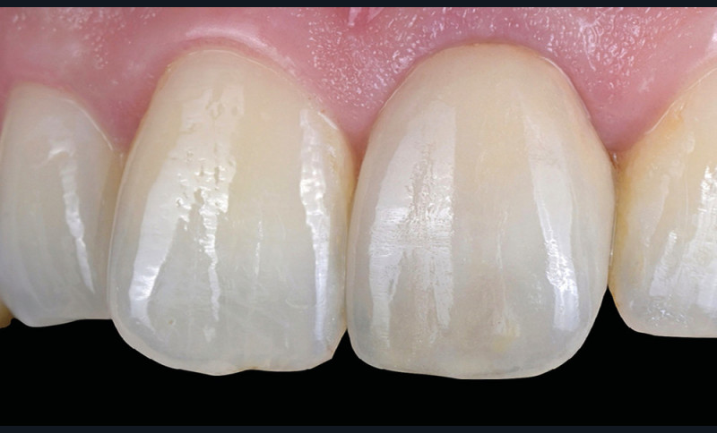 En images : le challenge de l’incisive centrale, optimisation du ...