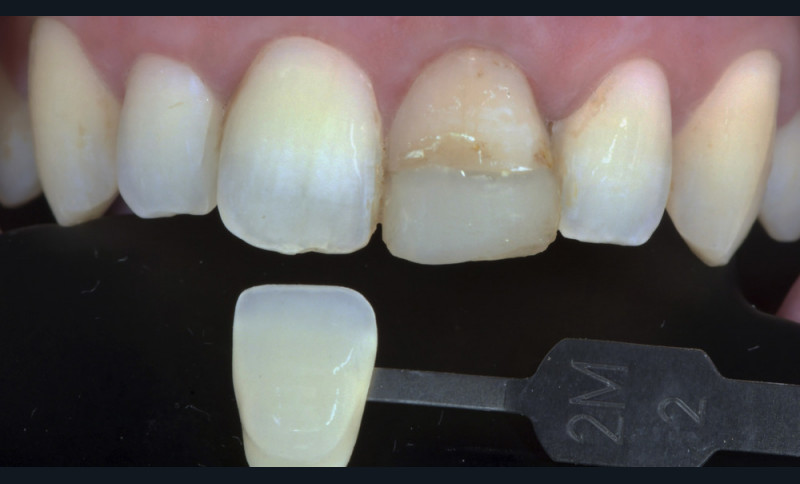 En images : le challenge de l’incisive centrale, optimisation du ...