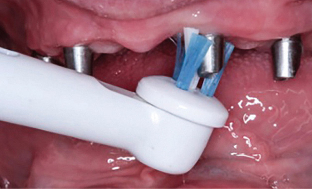 La visite de maintenance en prothèse implantaire – L'Information Dentaire