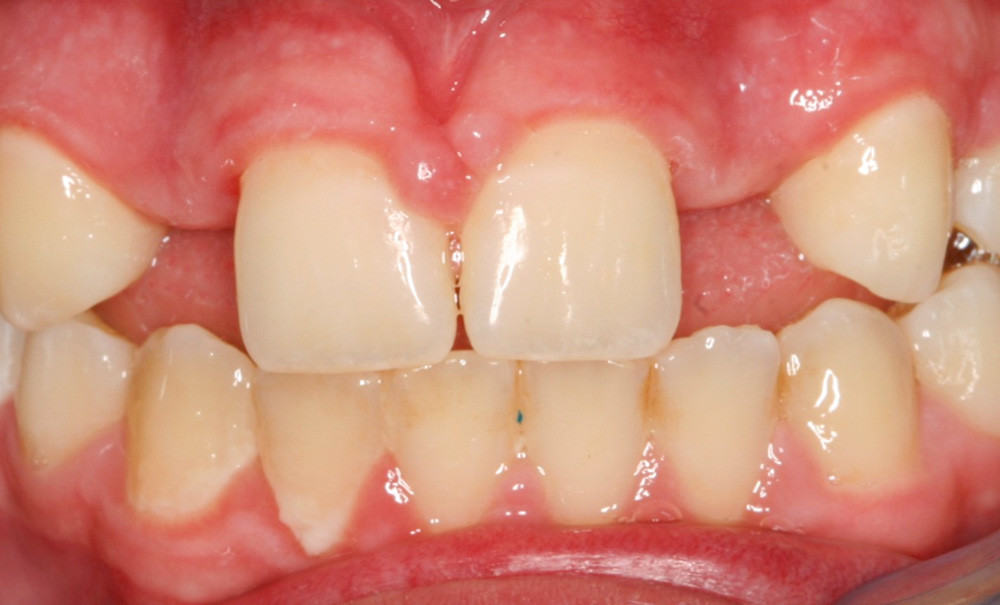 Approches multiples et variées pour contenir l’espace des incisives ...