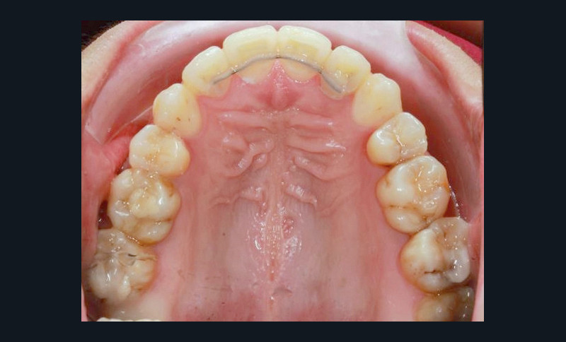 Recommandations sur la contention – L'Information Dentaire