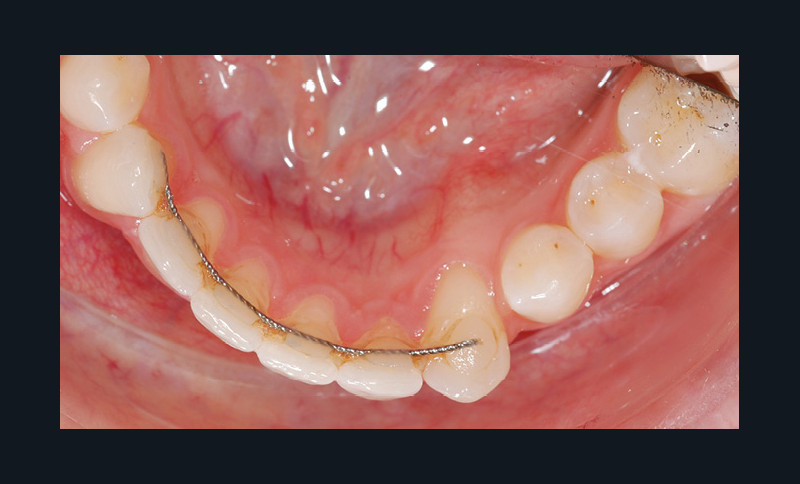 Gestion de la « période de contention » chez l’adulte – L'Information ...