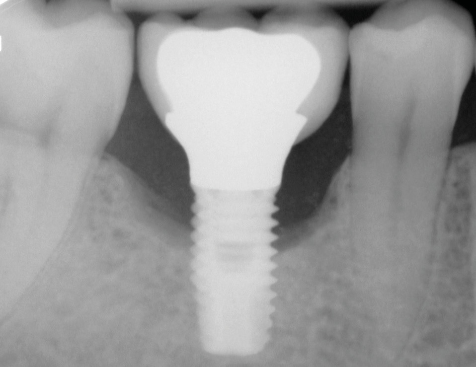 Une stratégie « zéro péri-implantite » est-elle possible ?Hiérarchiser ...