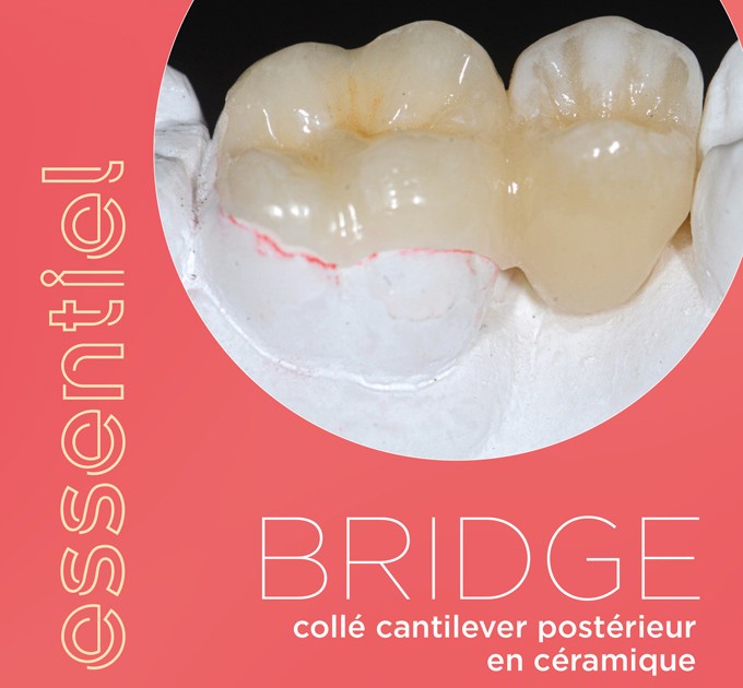 ESSENTIEL Bridge collé cantilever postérieur en céramique – L ...