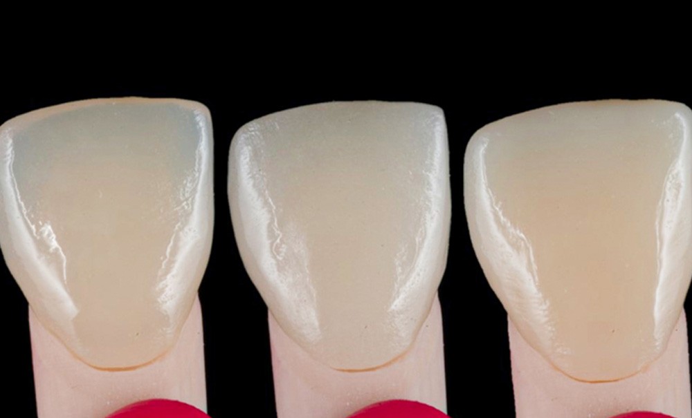 Les disilicates de lithium – L'Information Dentaire