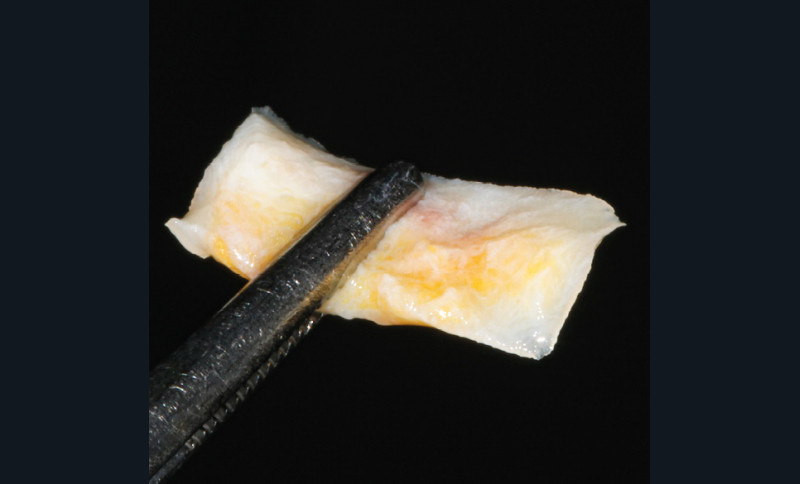 Traitement d’une péri-implantite : le choix du « tout laser » – L ...