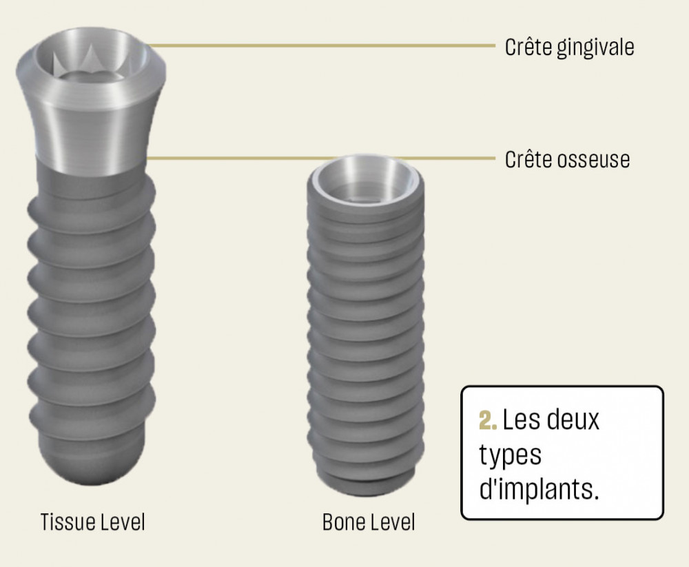 Tissue Level contre Bone Level – L'Information Dentaire