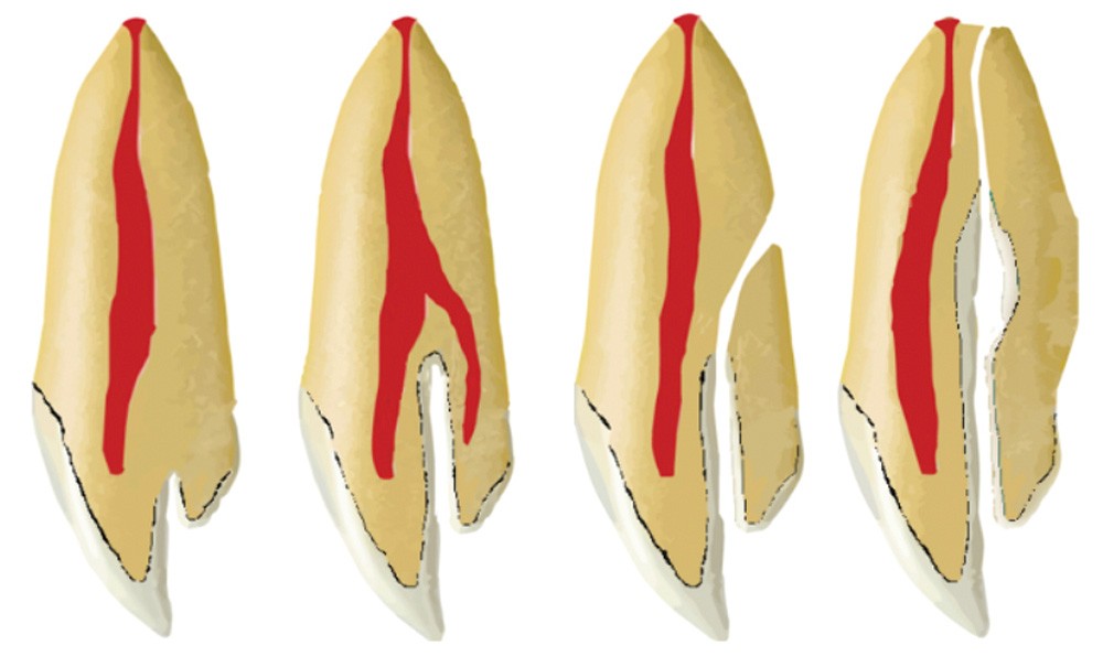 Différentes alternatives thérapeutiques de prise en charge de la dens ...