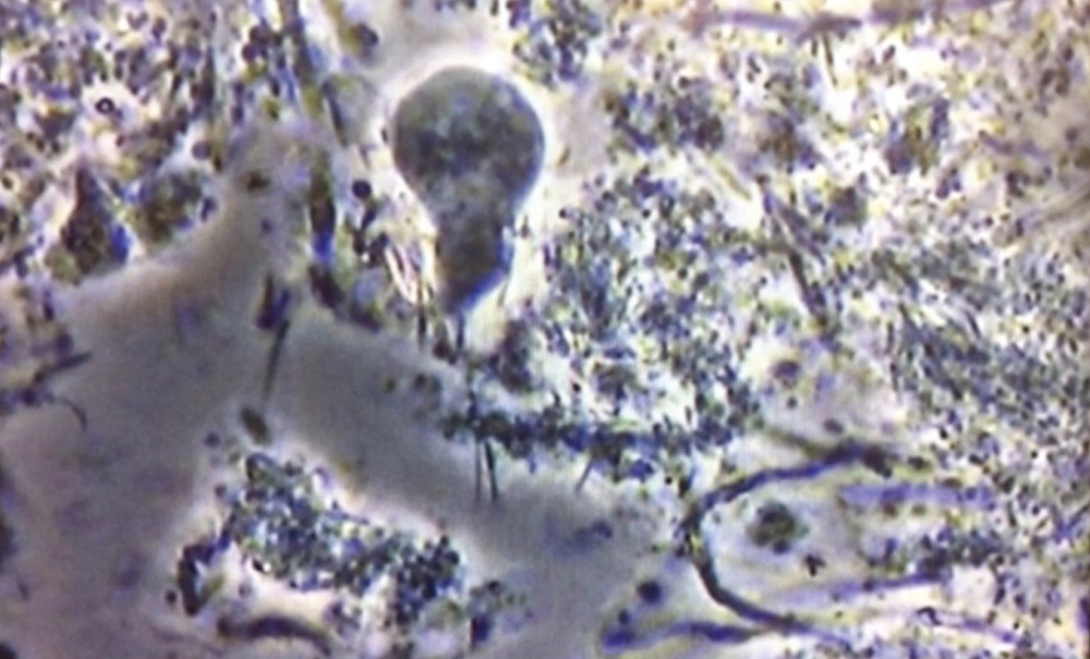 Trichomonas tenax – L'Information Dentaire