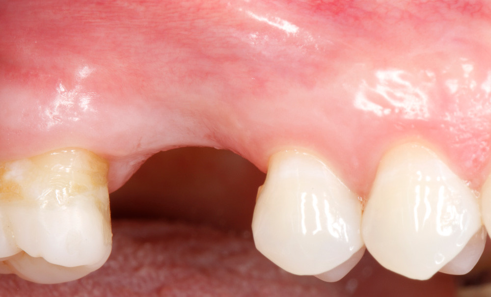 La régénération osseuse guidée en implantologie : une approche ...