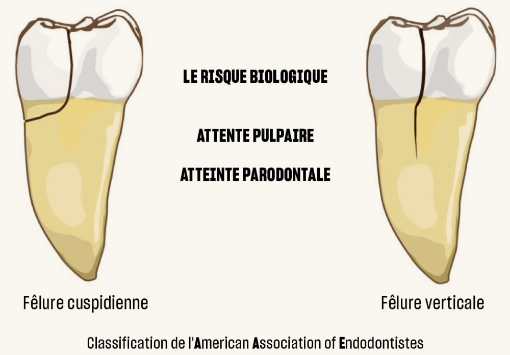 Diagnostiquer les fêlures, éviter les fractures – L'Information Dentaire