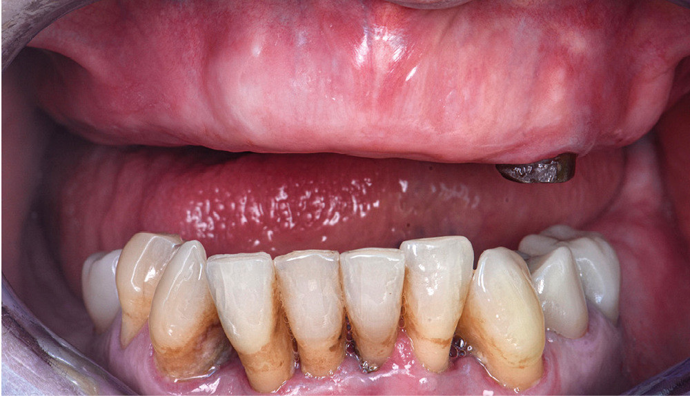 Apport du numérique dans la gestion d’une arcade édentée en bridge ...