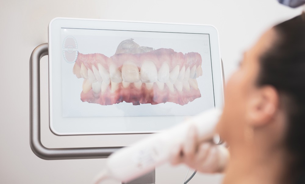 L’empreinte optique en implantologie – L'Information Dentaire