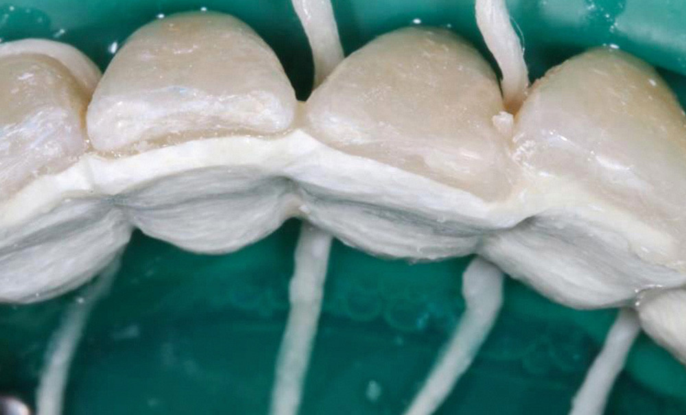 Prise en charge d’un secteur incisif mandibulaire mobile – L ...