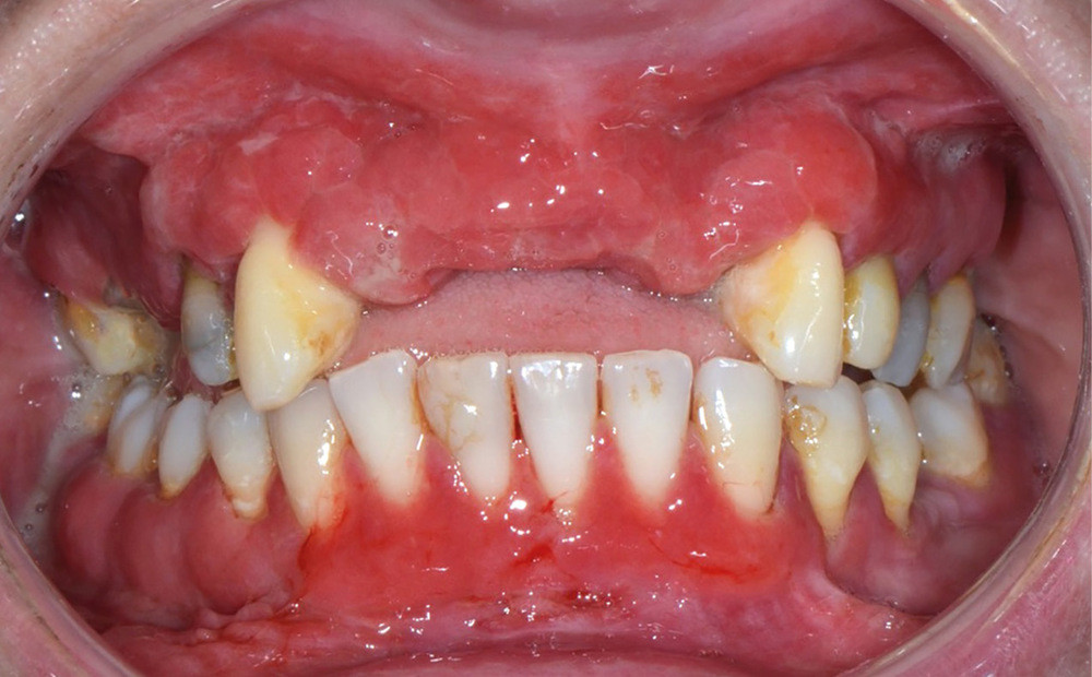 Gingivite à plasmocytes : entité pathologique ou inflammation gingivale ...