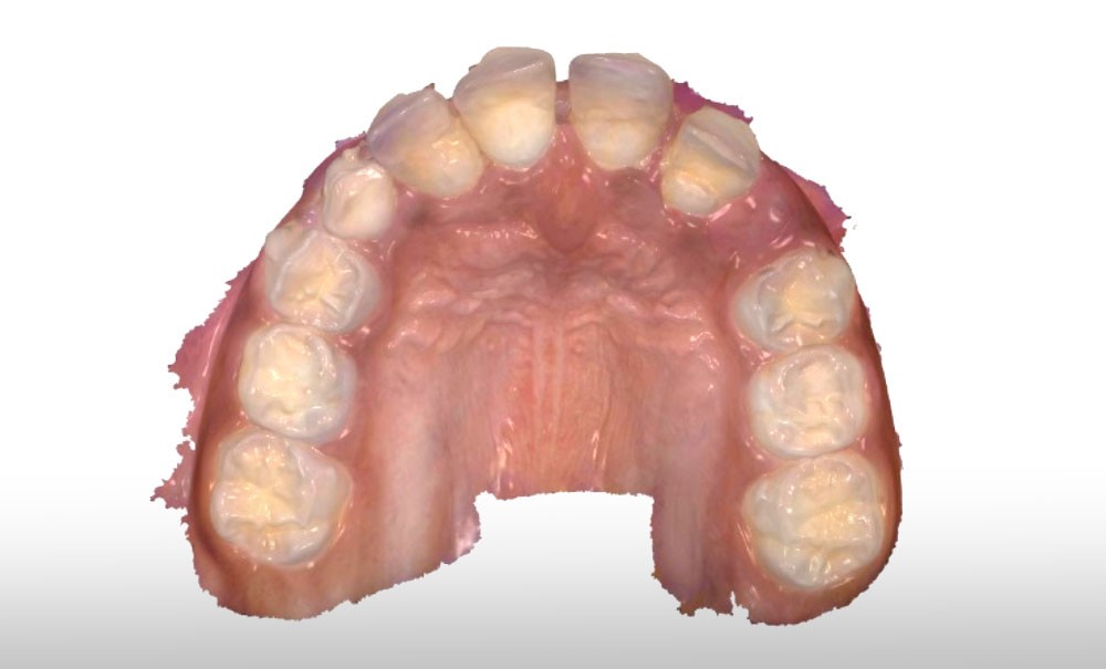 Gestion prothétique d’un cas de résorptions radiculaires externes post ...