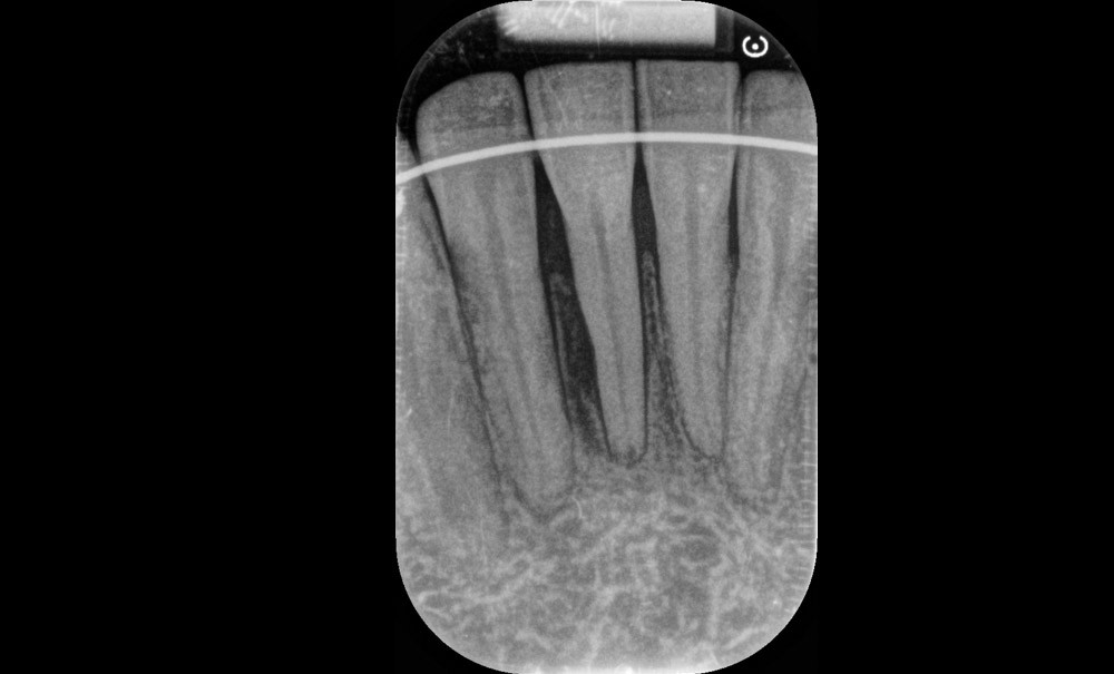 Lésions endo-parodontales et pronostic thérapeutique – L'Information ...